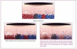 PicoWay | Edmonton Dermatology │ Nakatsui DermaSurgery