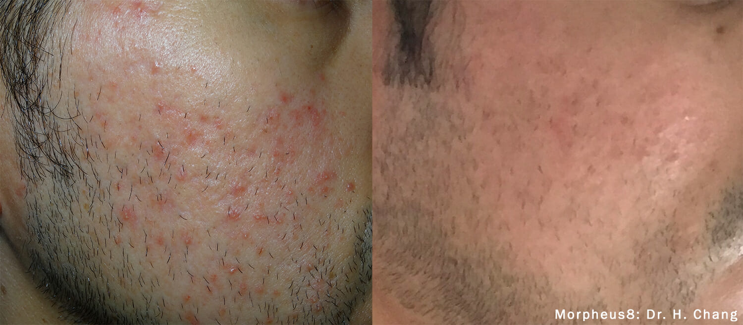 Morpheus8 RF microneedling | Edmonton | Nakatsui DermaSurgery