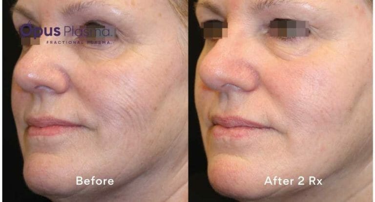 OPUS Plasma Skin Resurfacing | Edmonton | Nakatsui Derm OPUS Plasma Skin Resurfacing | Edmonton | Nakatsui Derm