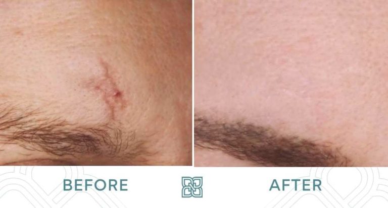 Scar Removal & Revision Edmonton | Laser & Subcision | Dr. Nakatsui