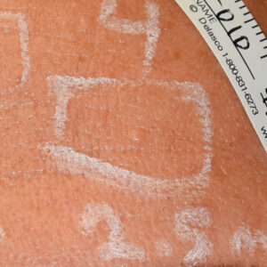 Sebaceous Hyperplasia | Edmonton Dermatology | Nakatsui Derm