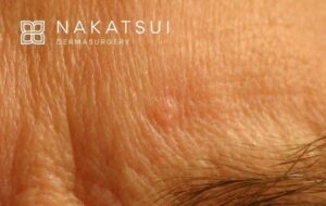 Sebaceous Hyperplasia | Edmonton Dermatology | Nakatsui Derm
