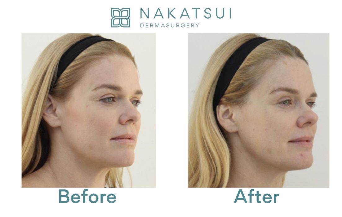 InstaLift Thread lift Edmonton | Edmonton Dermatology │ Nakatsui ...